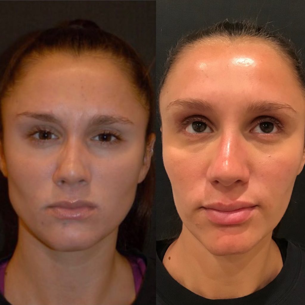 Treating Grinding with Botox Munster IN - Restore Center for